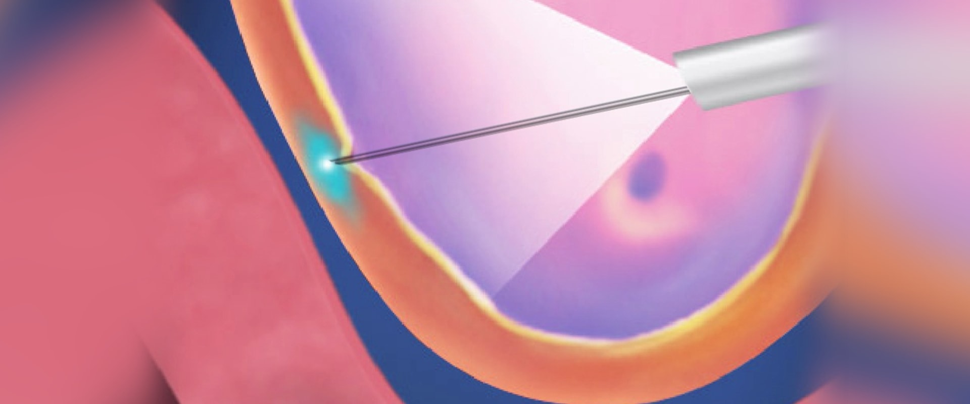 How Long Does Botox Last for Bladder Conditions?