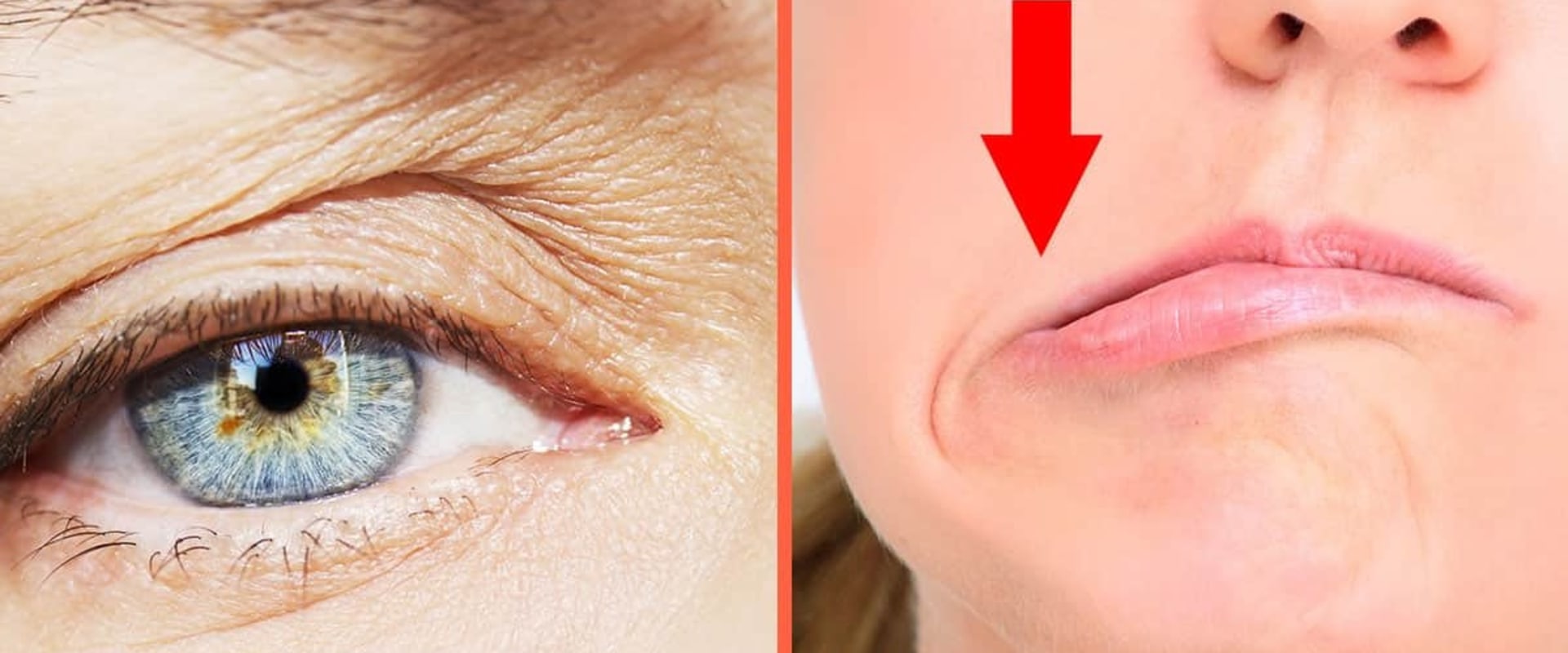 What are the side effects of facial botox?