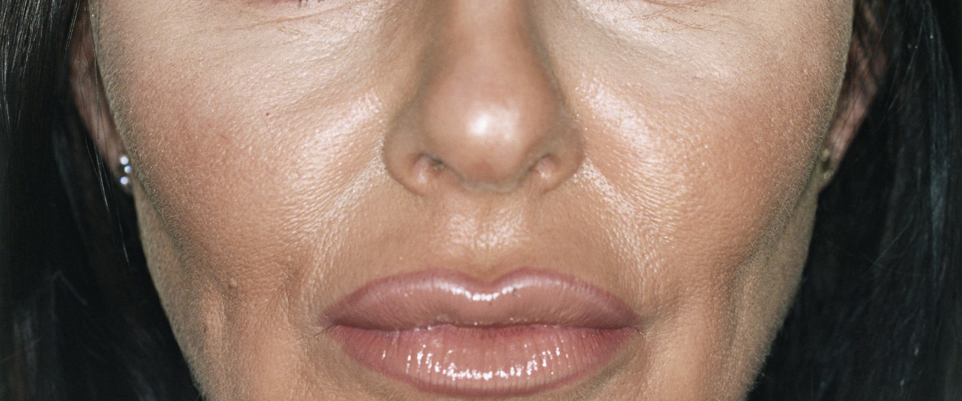 The Risks of Botox: What You Need to Know